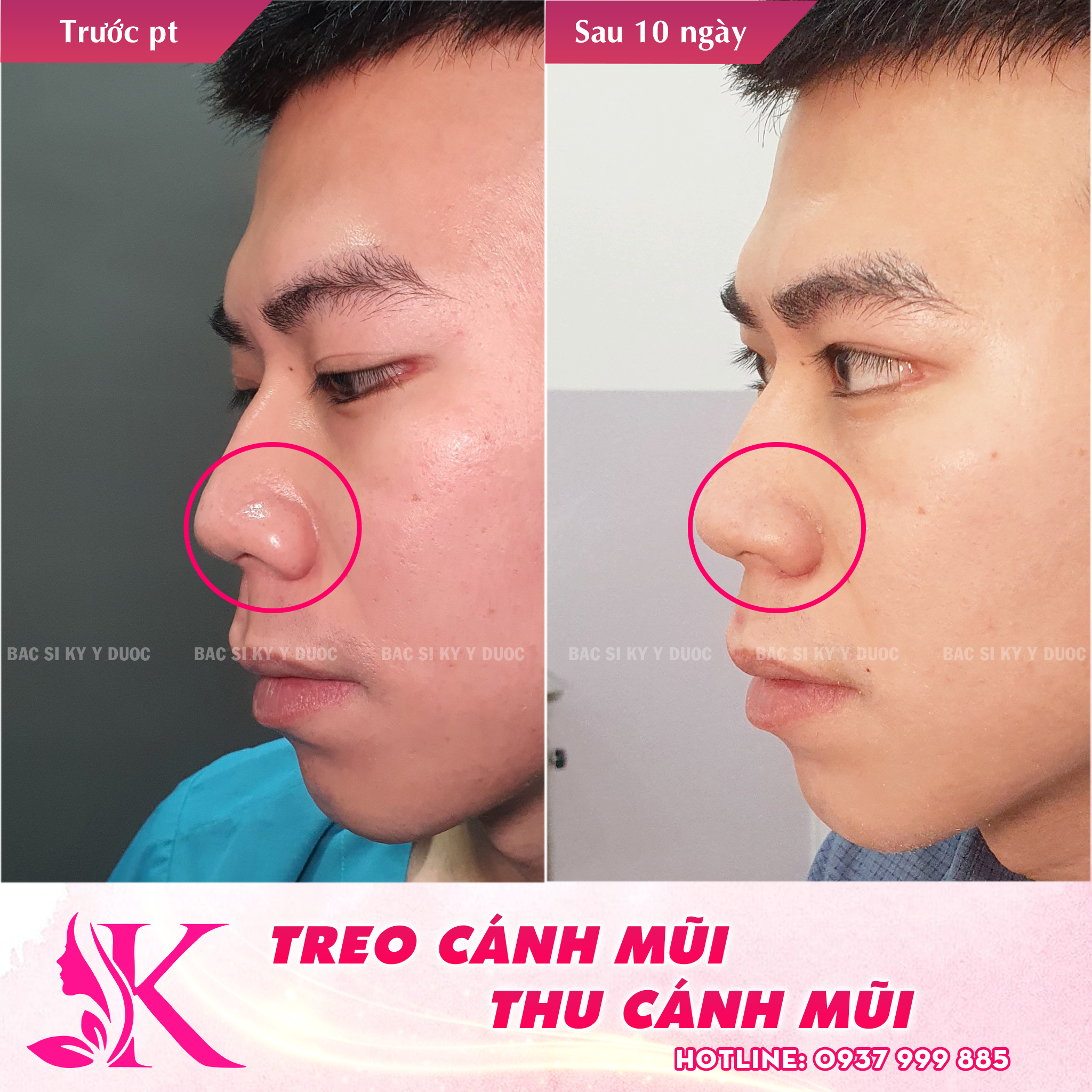 Treo cánh mũi an toàn - hài hoà gương mặt - Phẫu thuật Thẩm mỹ Bác sĩ ...